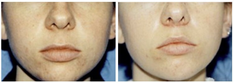 Lip Augmentation - MD Laser Spa - Robert F. Gray, MD, FACS