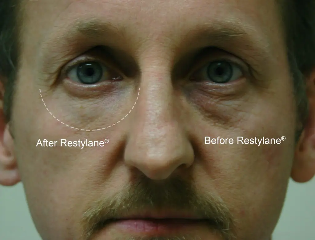 Restylane® - MD Laser Spa - Robert F. Gray, MD, FACS